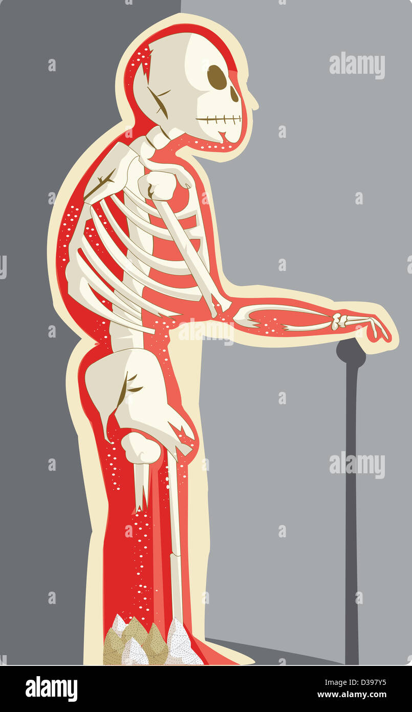The human skeleton with missing leg bone depicting Osteoporosis Stock ...