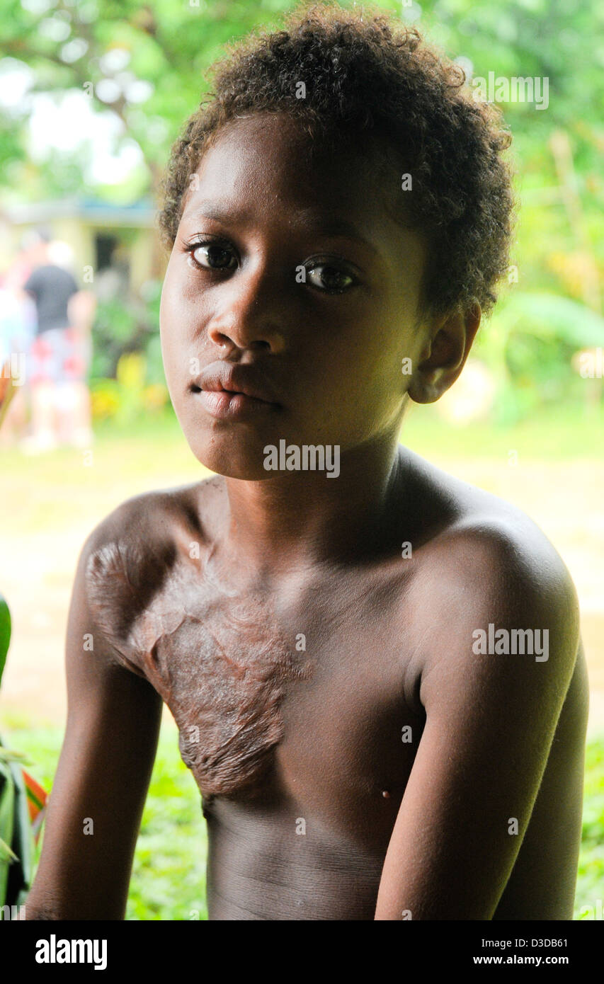 A scarred boy in the Pacific Islands looks sadly at the photographer ...