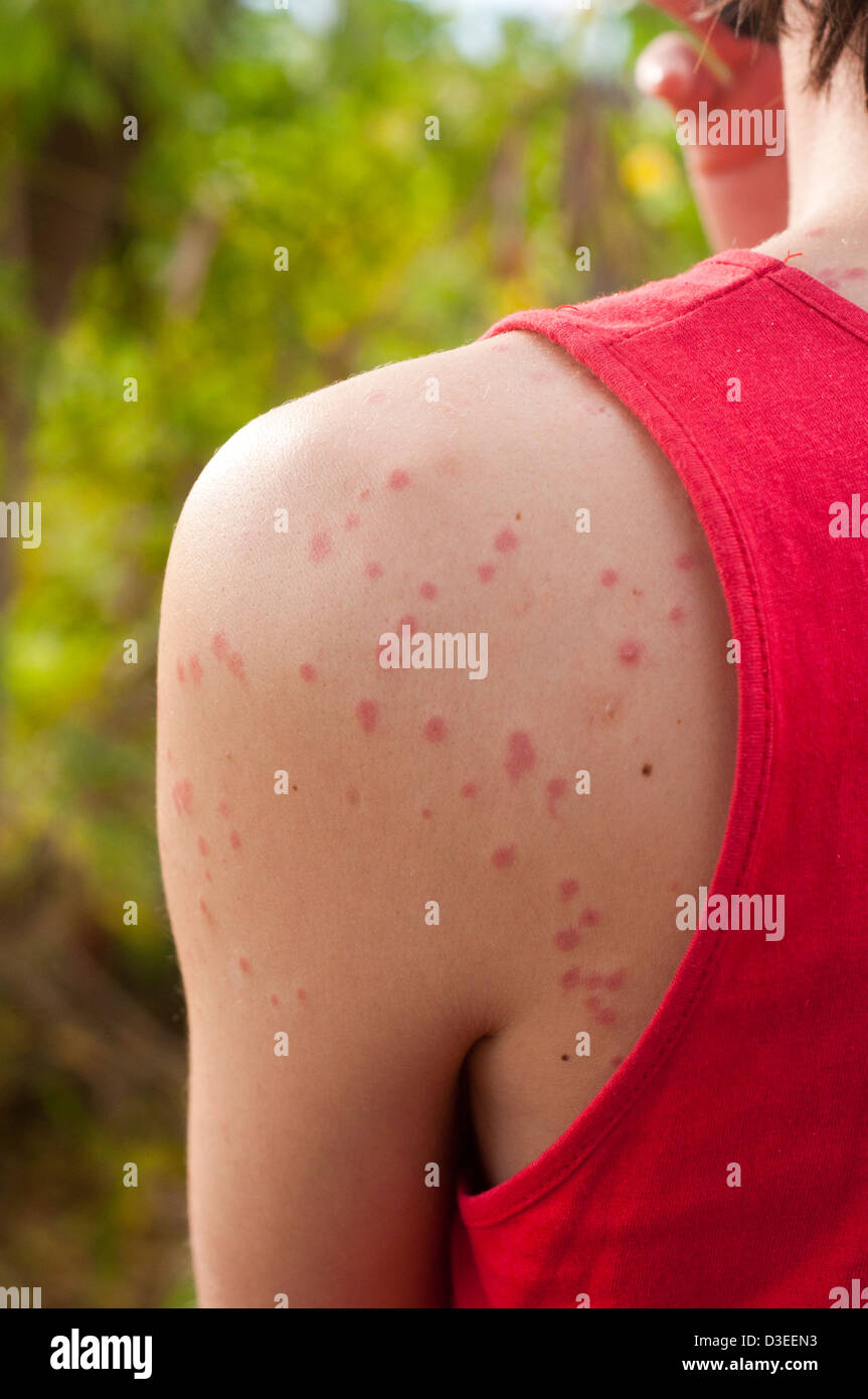 Mosquito bites hi-res stock photography and images - Alamy