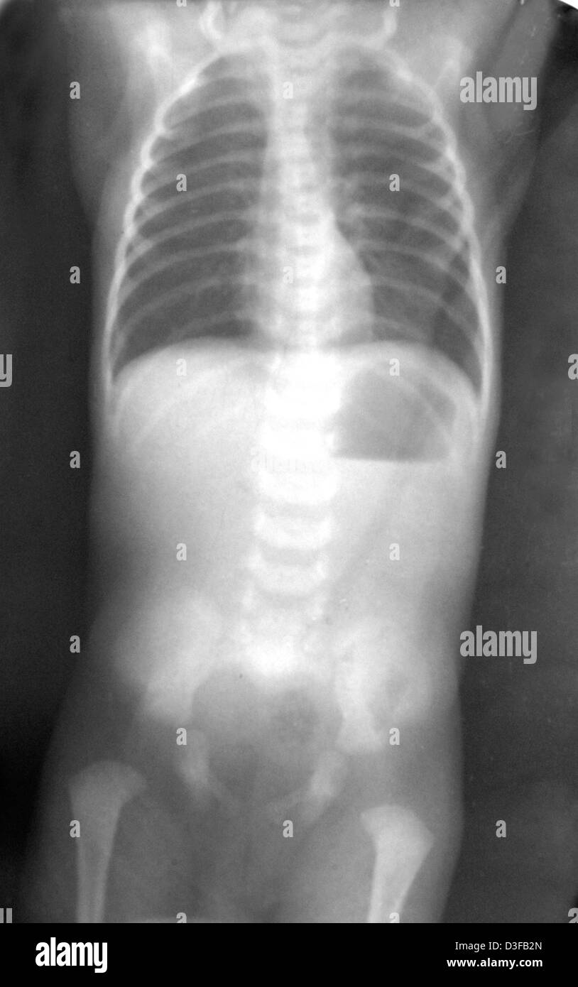 Pylorus Black and White Stock Photos & Images - Alamy