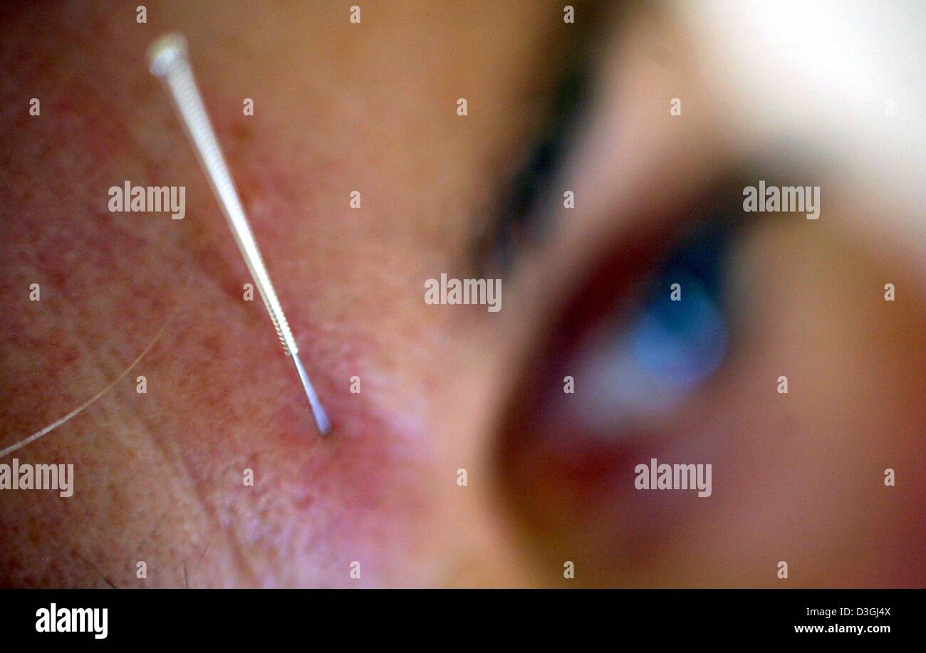 (dpa) - A patient is treated with an acupuncture needle in the nose ...