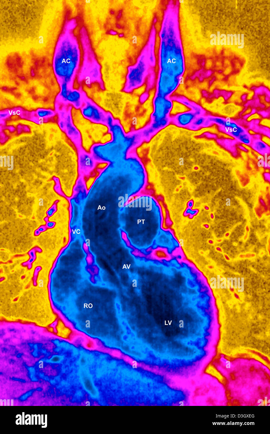 Heart mri artery hi-res stock photography and images - Alamy