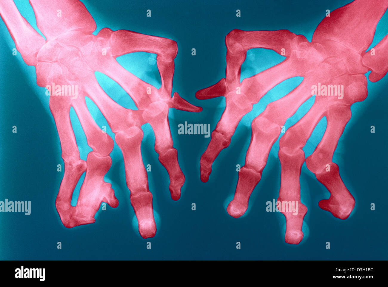 RHEUMATOID ARTHRITIS, X-RAY Stock Photo - Alamy