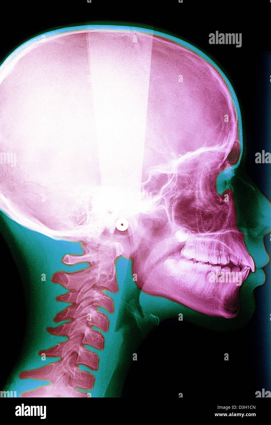 X RAY OF HEAD Stock Photo - Alamy