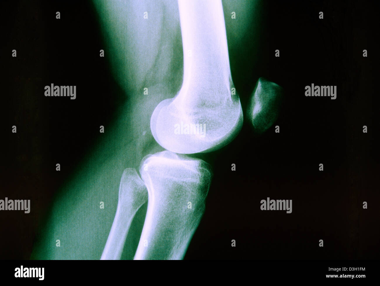 KNEE OSTEOARTHRITIS, X-RAY Stock Photo - Alamy