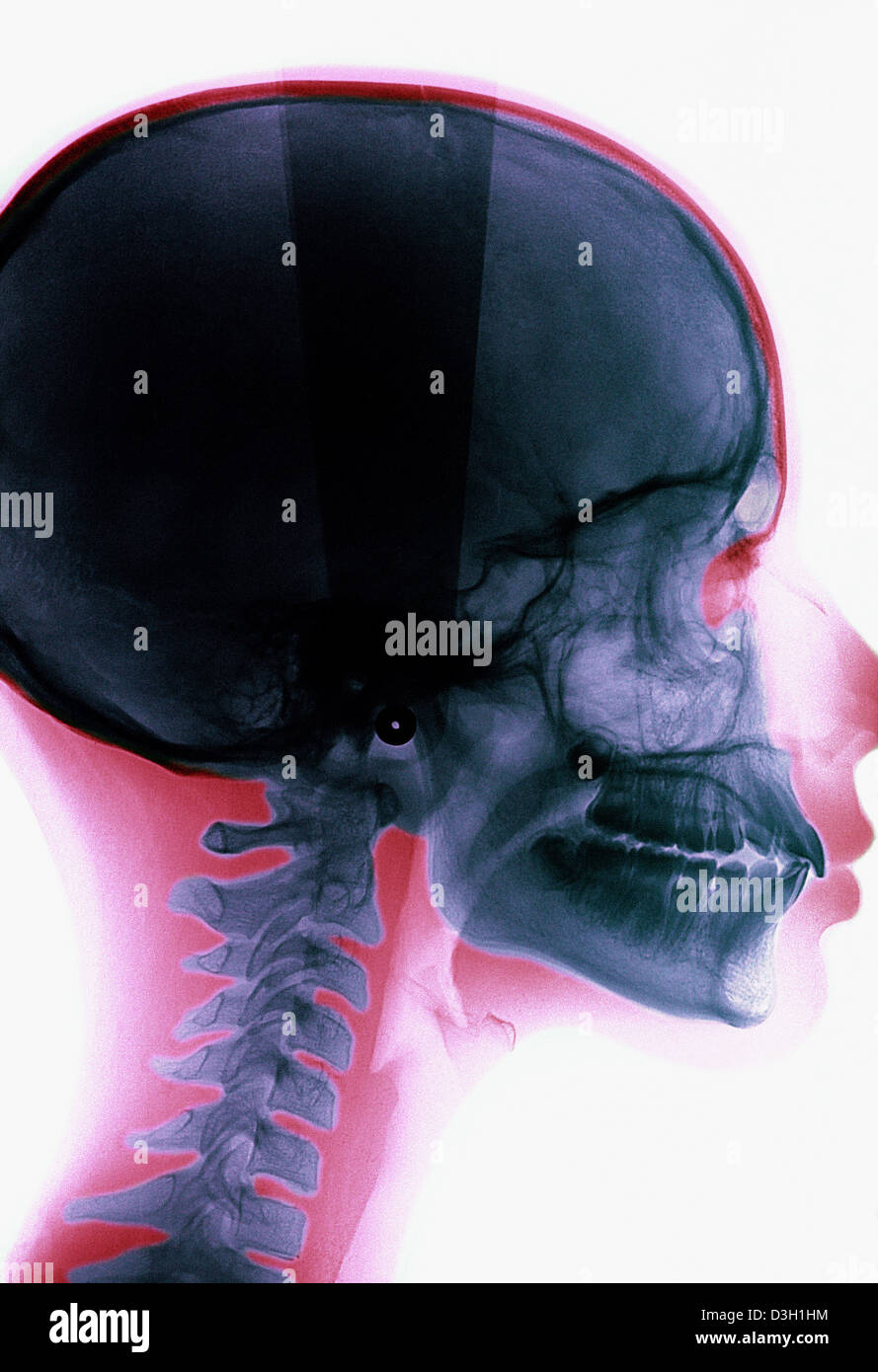 X RAY OF HEAD Stock Photo - Alamy