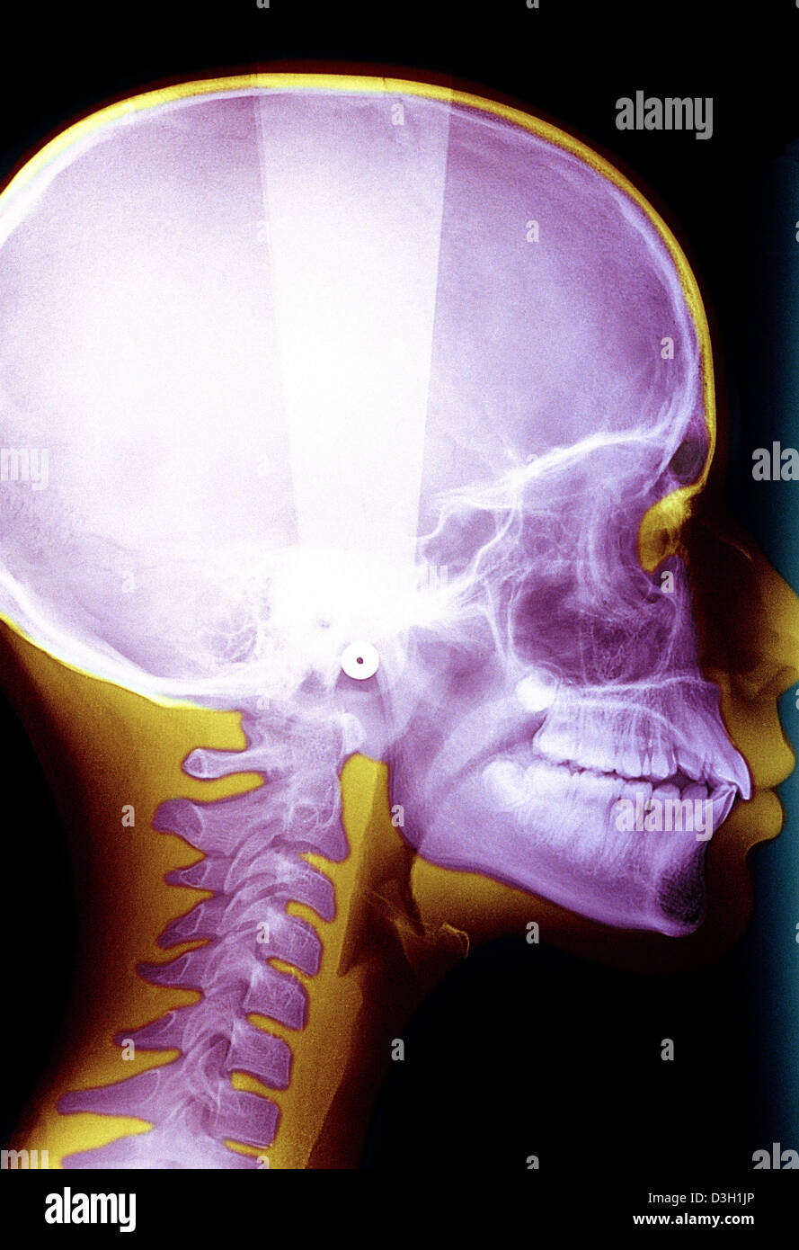 X RAY OF HEAD Stock Photo - Alamy