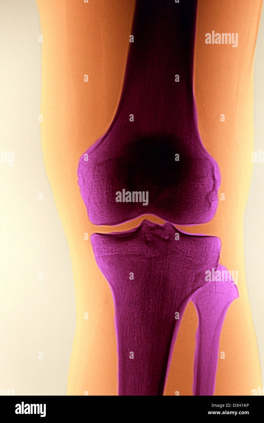 X ray knee normal hi-res stock photography and images - Alamy