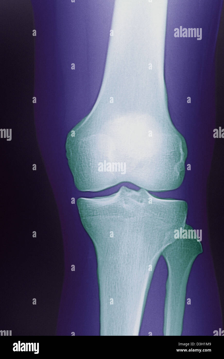 Normal knee x ray hi-res stock photography and images - Alamy