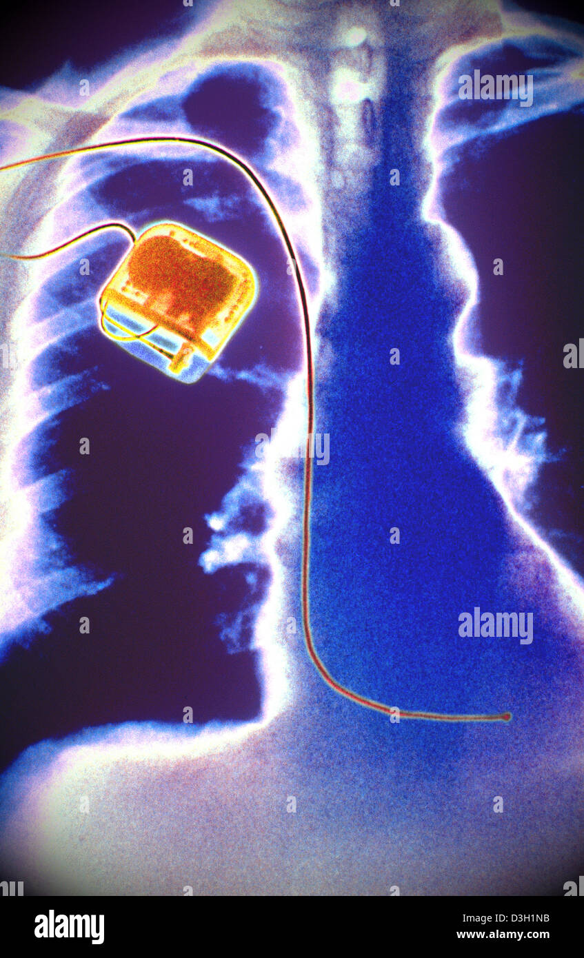Heart pacemaker x ray hi-res stock photography and images - Alamy