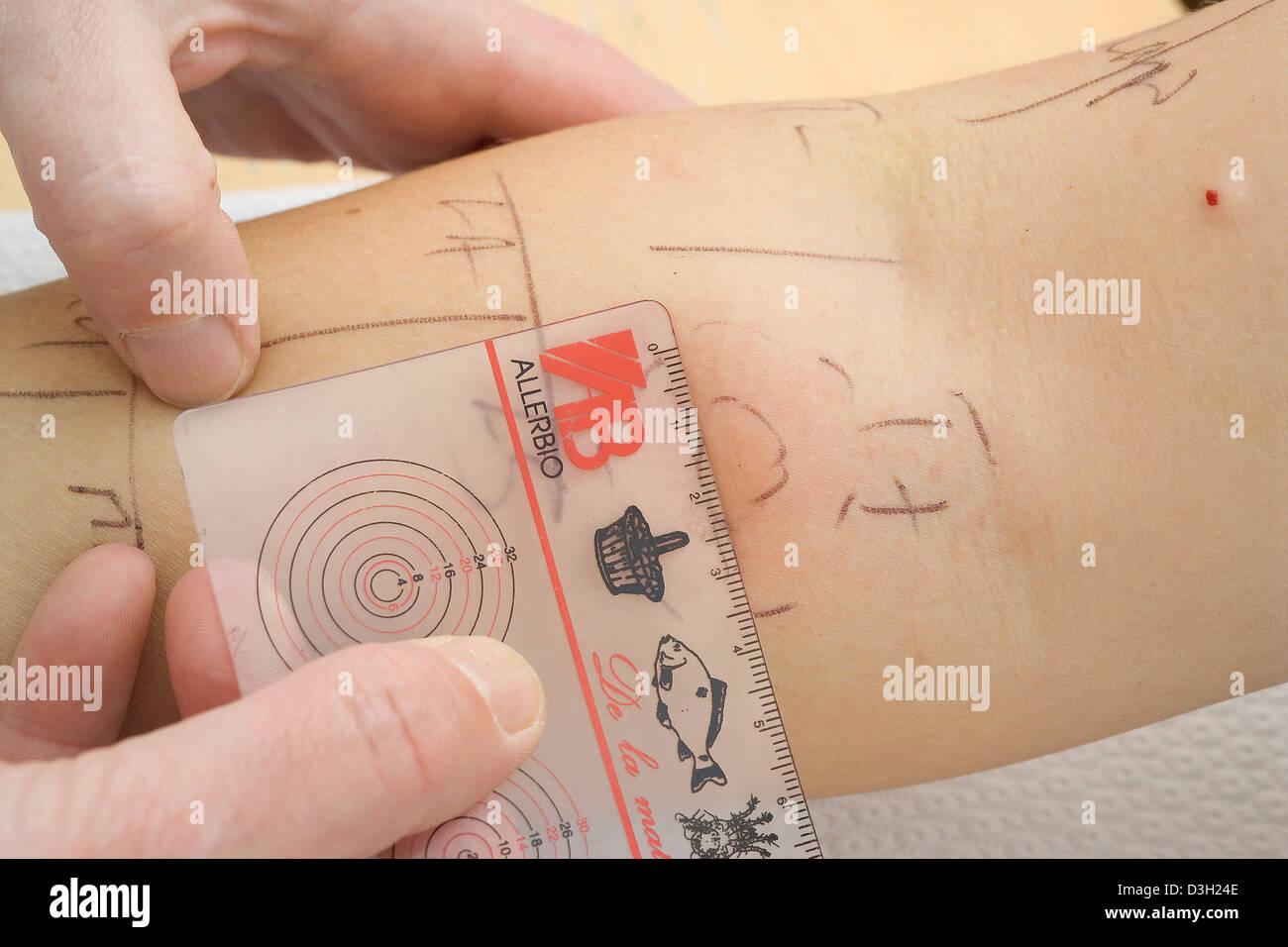 ALLERGY TEST, WOMAN Stock Photo - Alamy