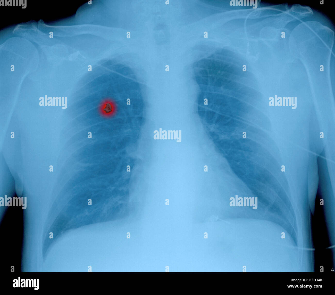 LUNG CANCER, X-RAY Stock Photo - Alamy