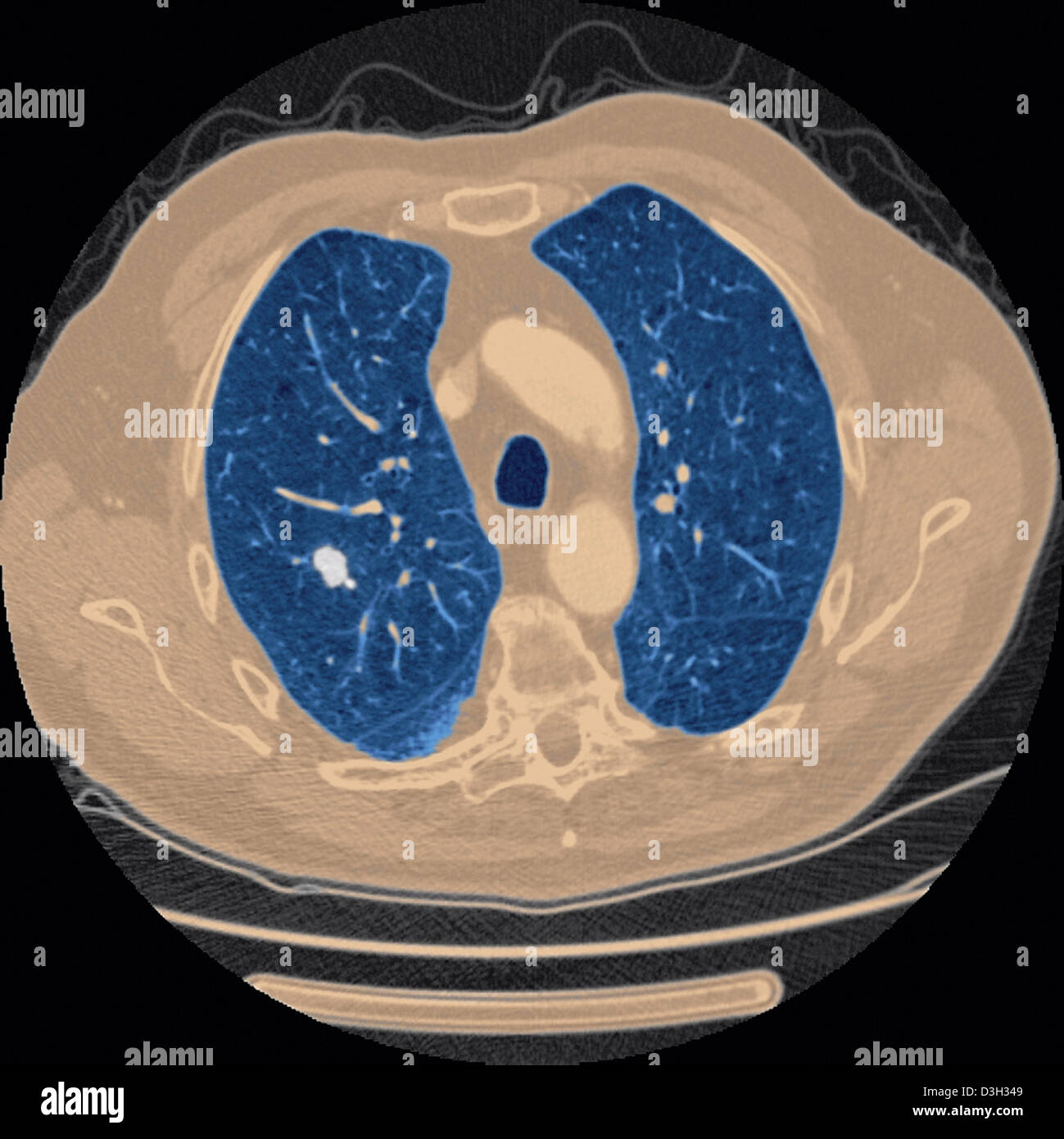 LUNG CANCER, SCAN Stock Photo - Alamy