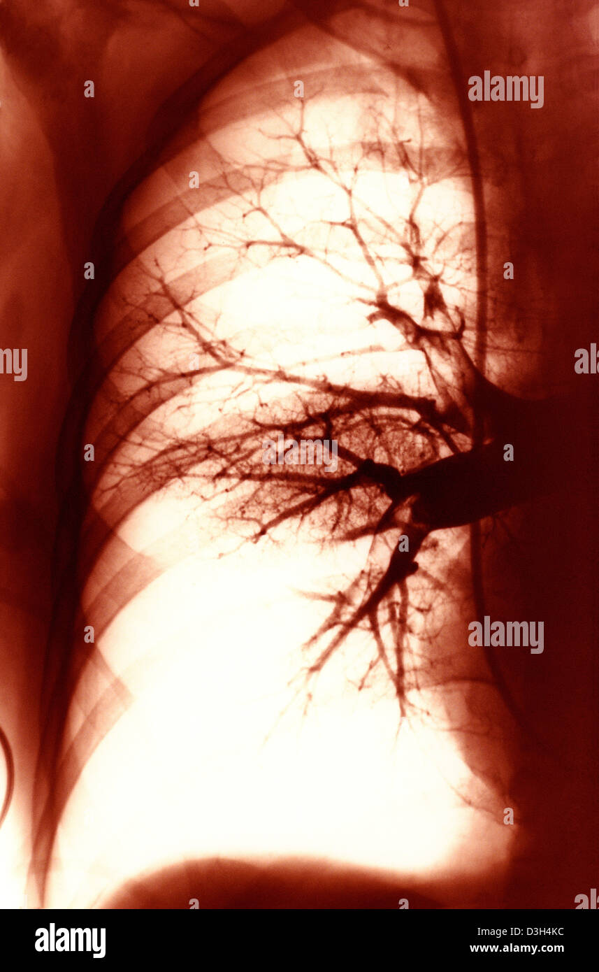 PULMONARY EMBOLISM, X-RAY Stock Photo - Alamy