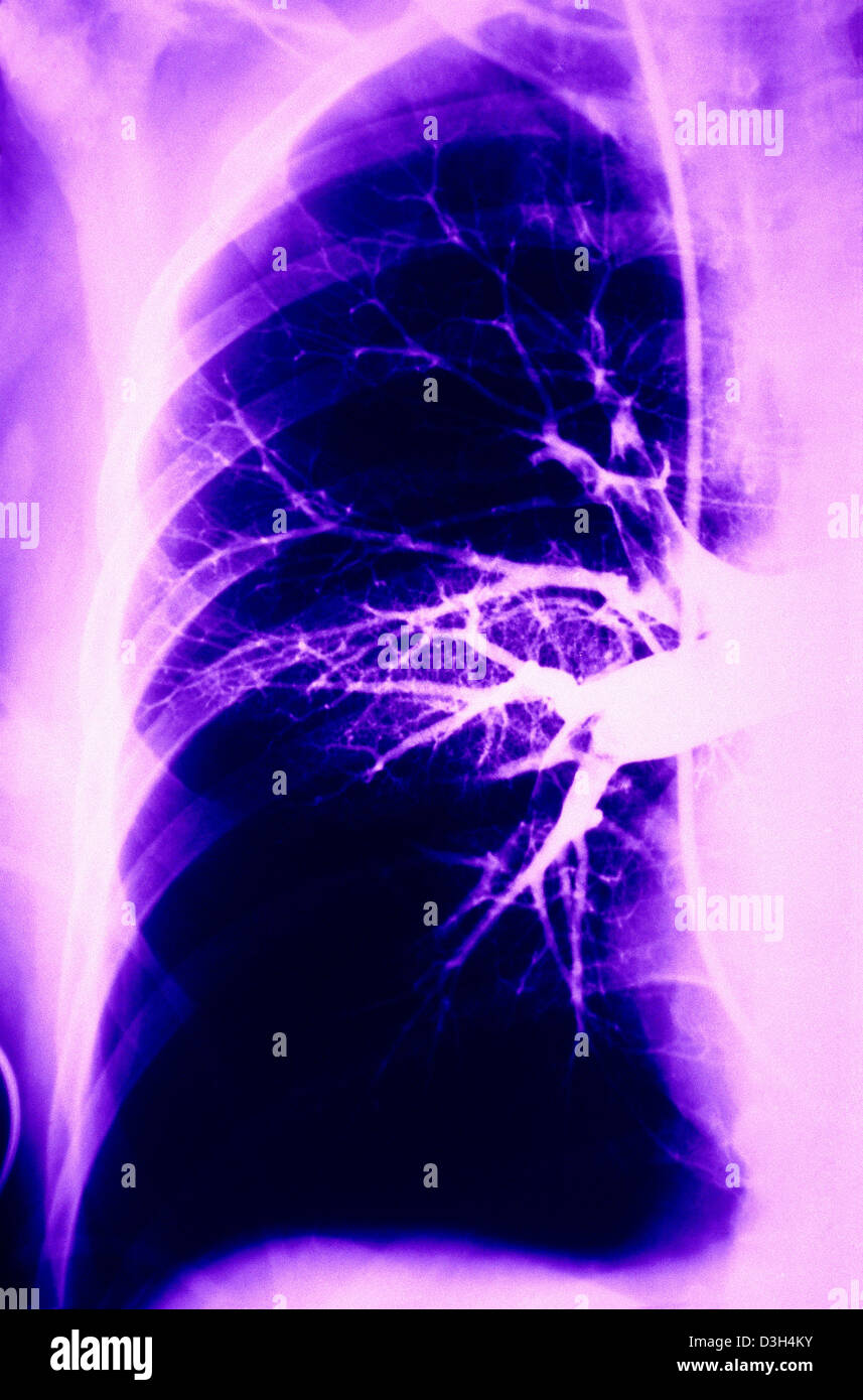 PULMONARY EMBOLISM, X-RAY Stock Photo - Alamy