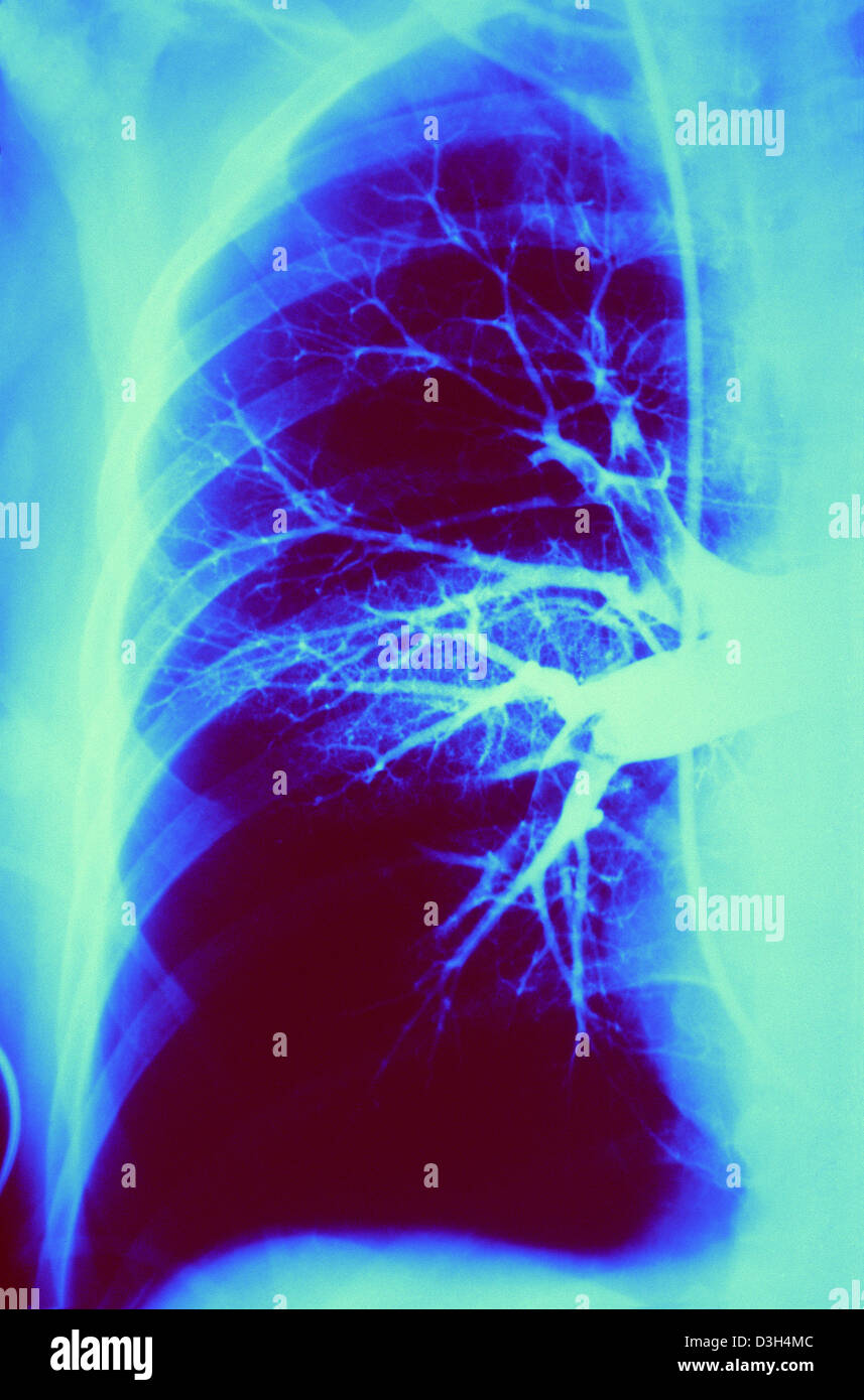PULMONARY EMBOLISM, X-RAY Stock Photo - Alamy