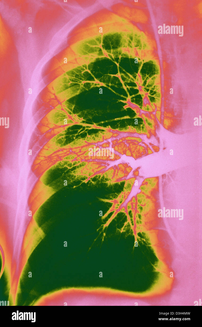 PULMONARY EMBOLISM, X-RAY Stock Photo - Alamy