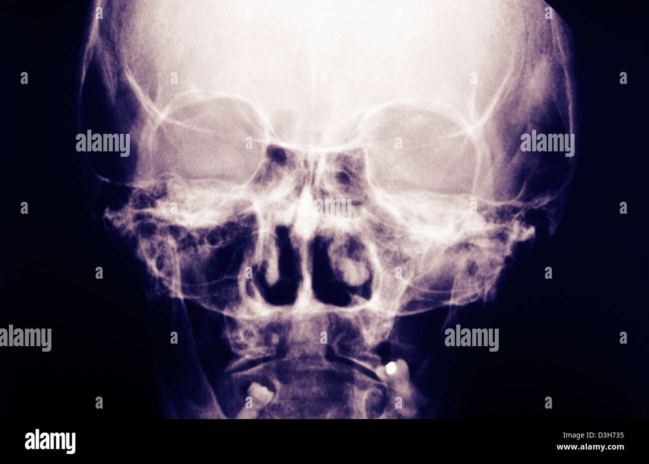 Normal x ray of sinuses hi-res stock photography and images - Alamy
