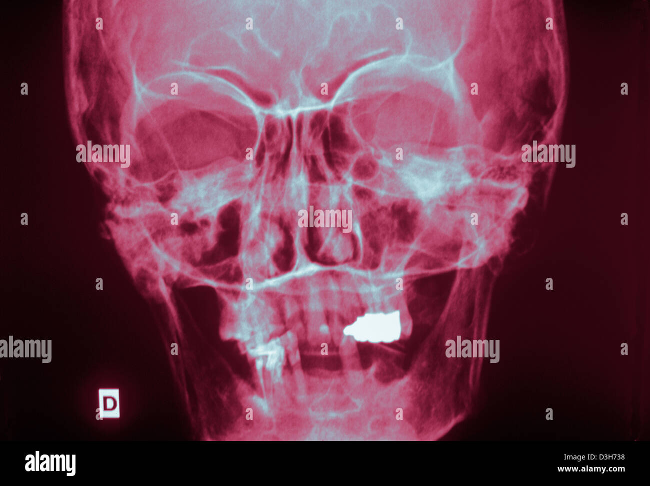 Normal x ray of sinuses hi-res stock photography and images - Alamy