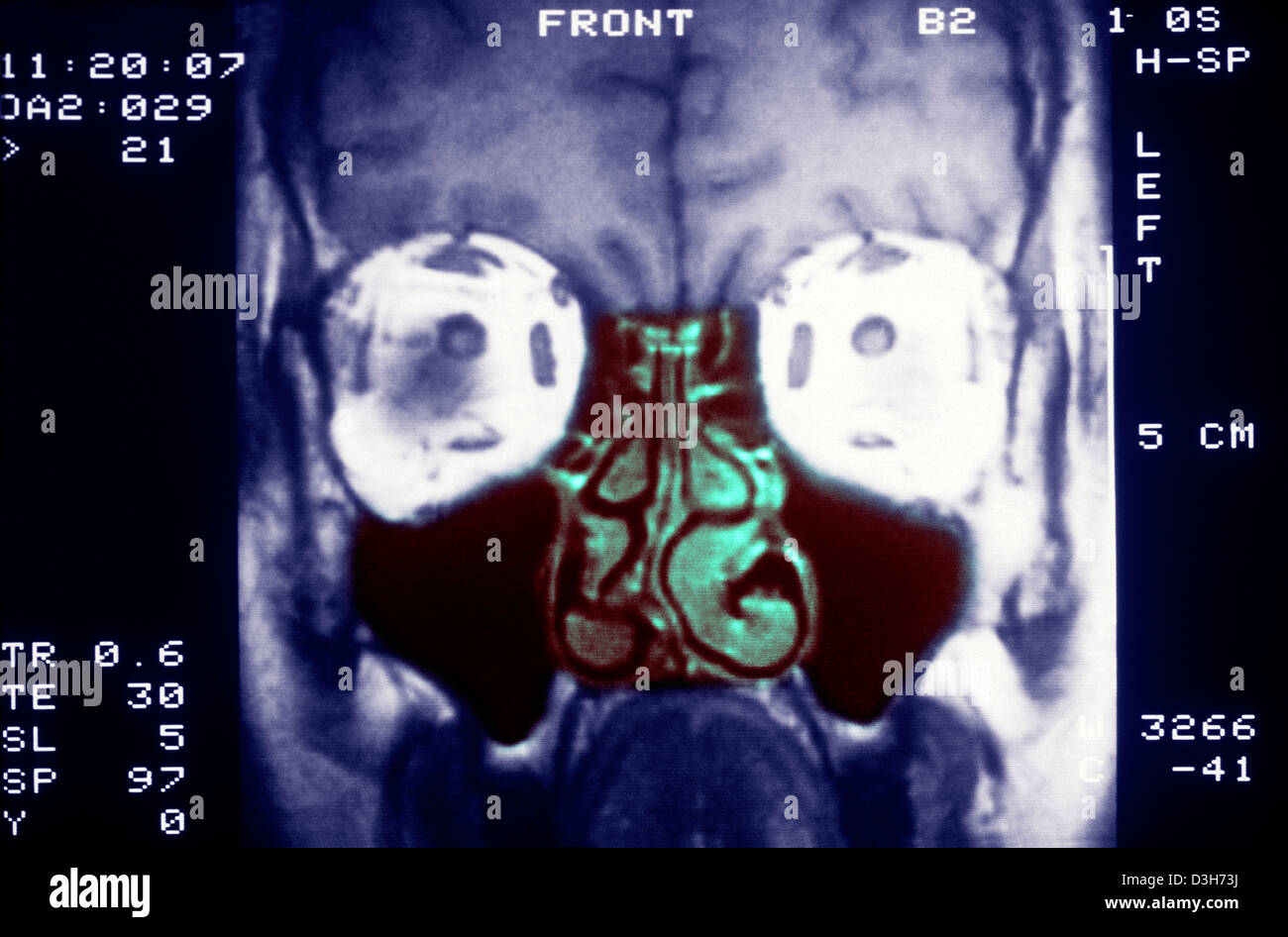 Normal mri sinuses hi-res stock photography and images - Alamy