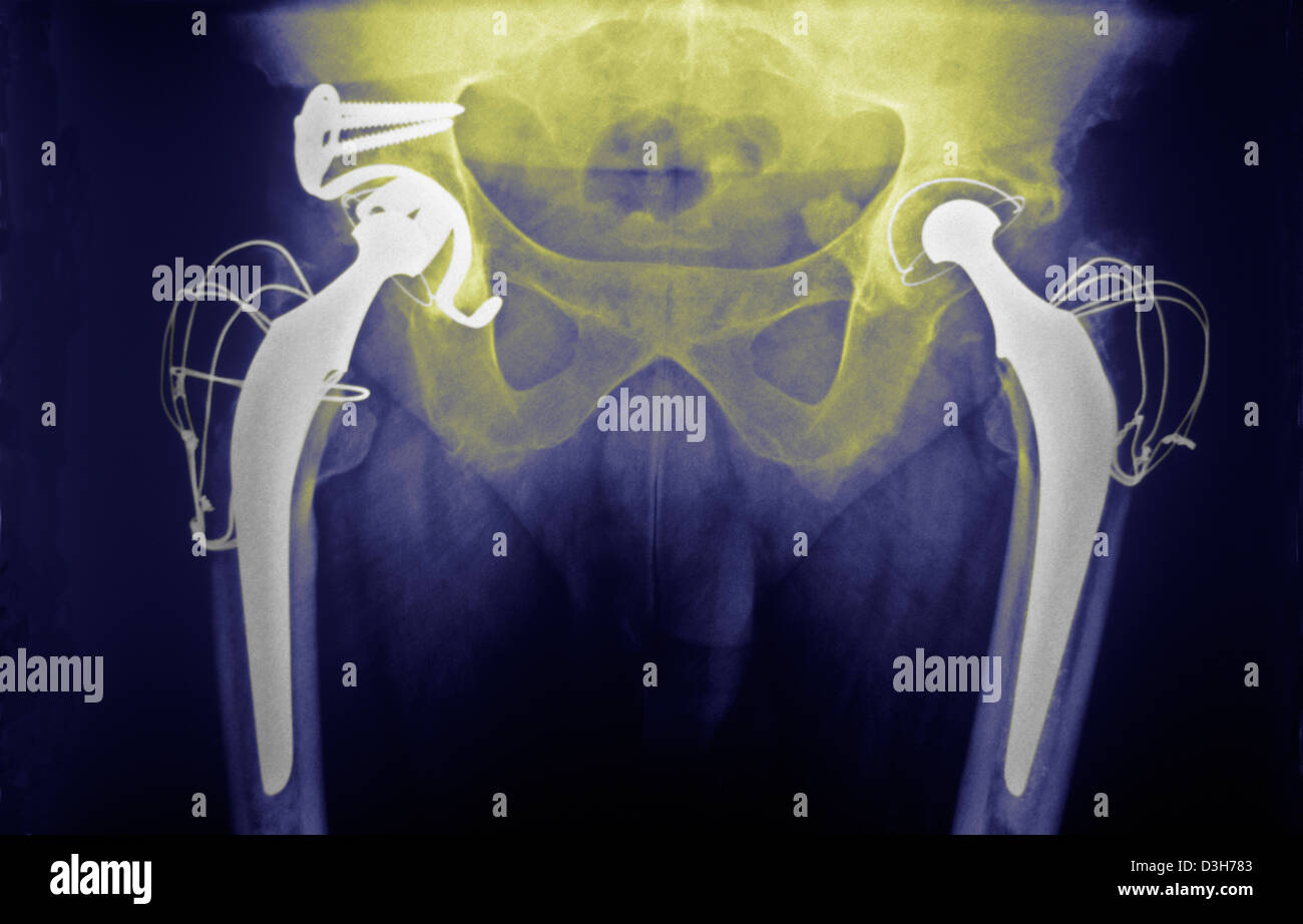 HIP PROSTHESIS, X-RAY Stock Photo - Alamy