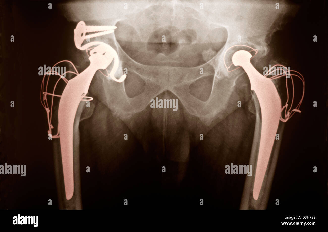 HIP PROSTHESIS, X-RAY Stock Photo - Alamy HIP PROSTHESIS, X-RAY Stock Photo - Alamy