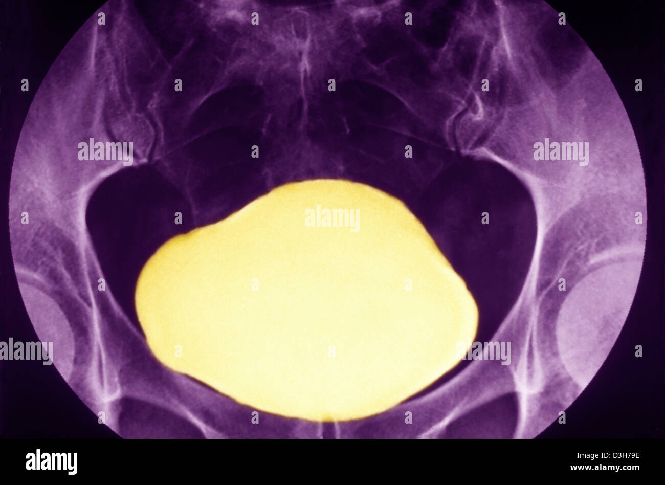 Bladder X Ray Result High Resolution Stock Photography and Images - Alamy