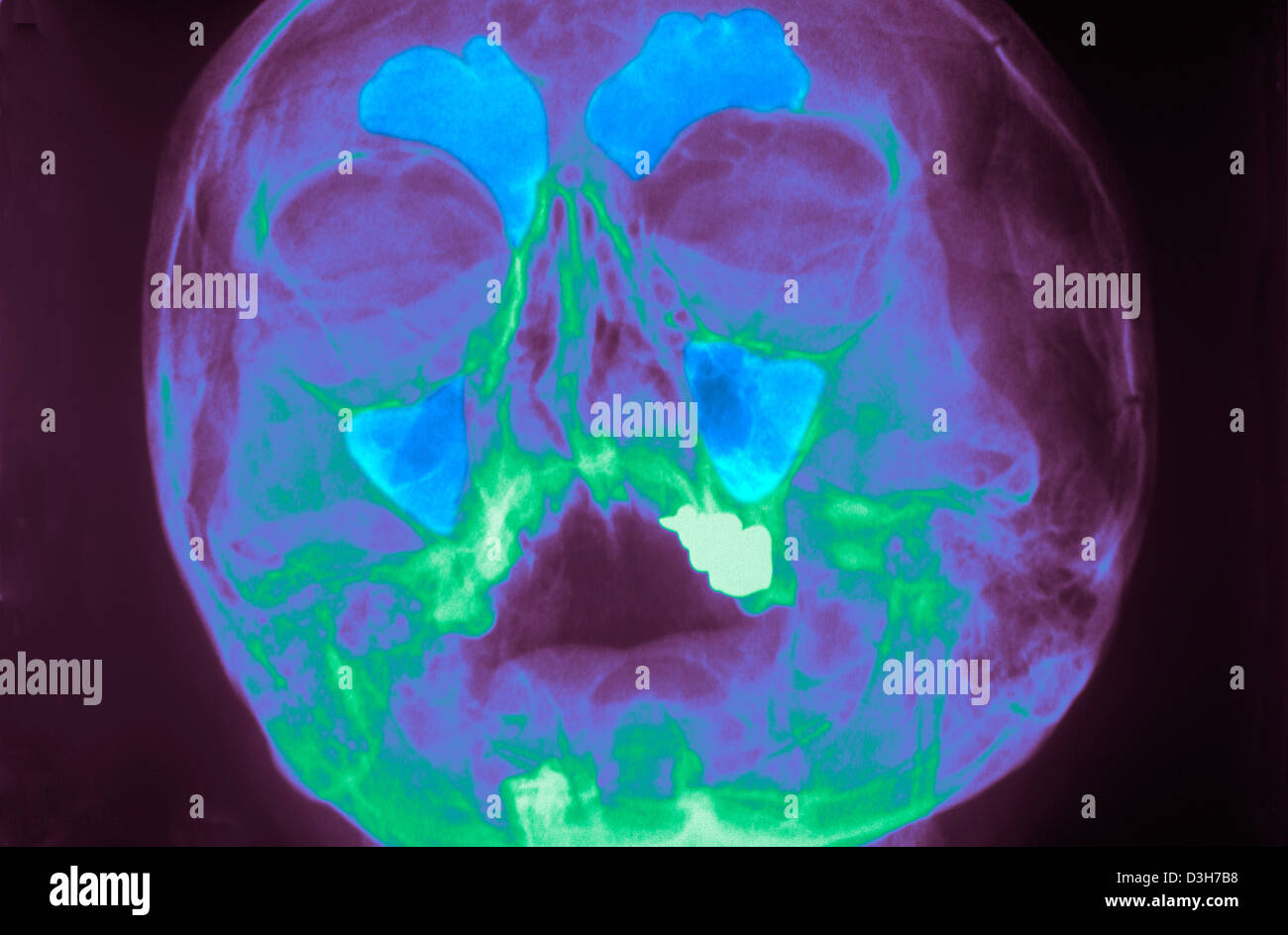 Normal x ray of sinuses hi-res stock photography and images - Alamy