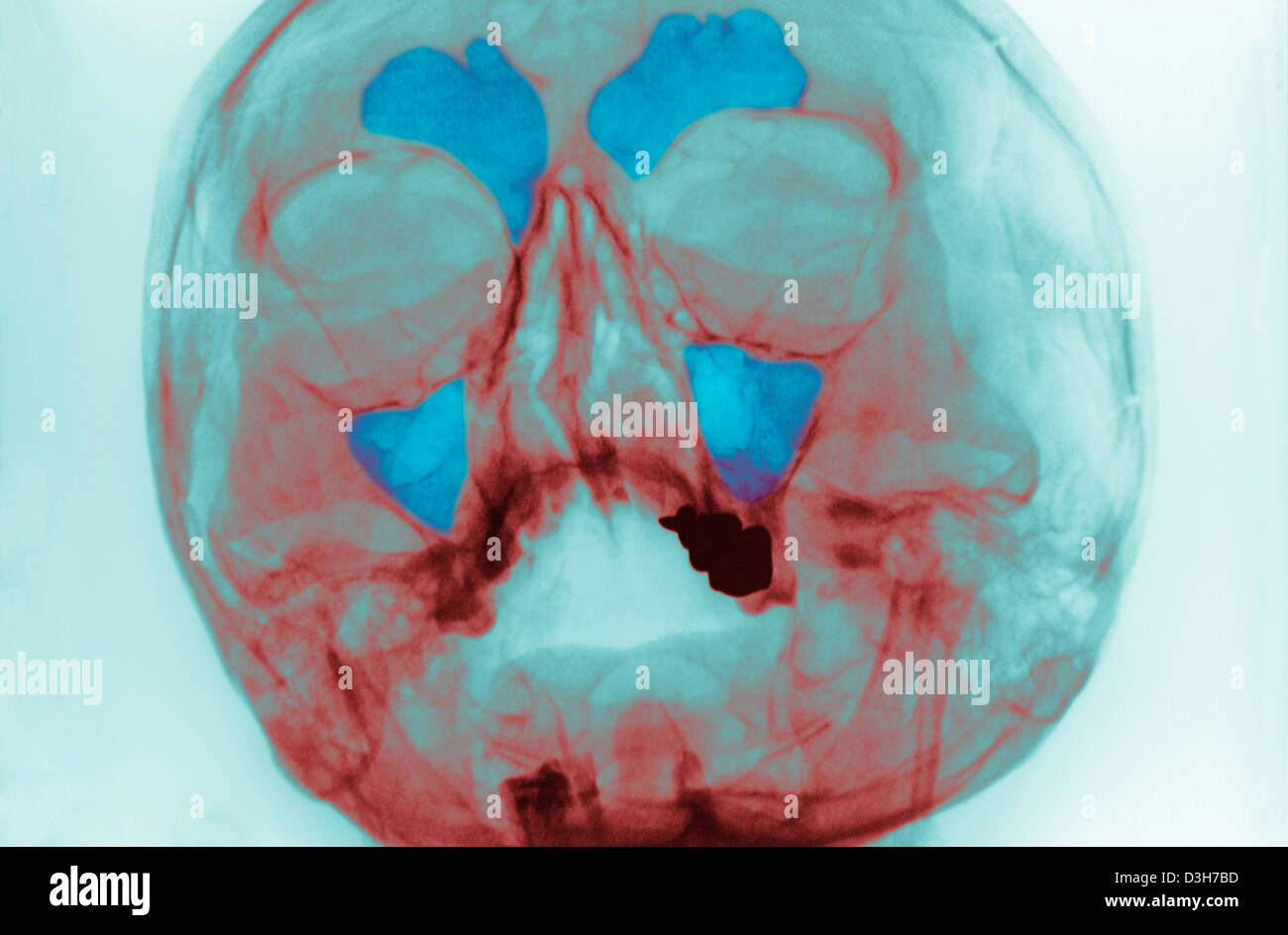 Normal x ray of sinuses hi-res stock photography and images - Alamy