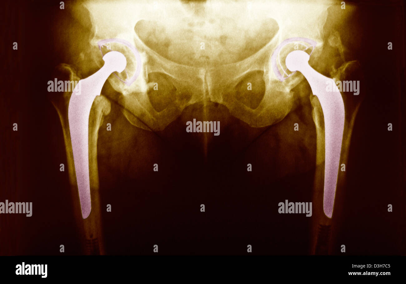HIP PROSTHESIS, X-RAY Stock Photo - Alamy