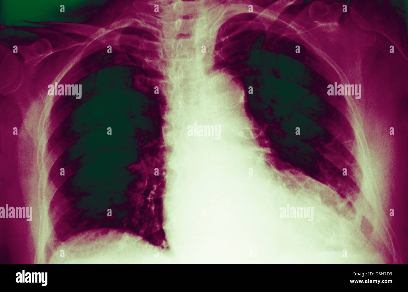 Cardiomegaly hi-res stock photography and images - Alamy