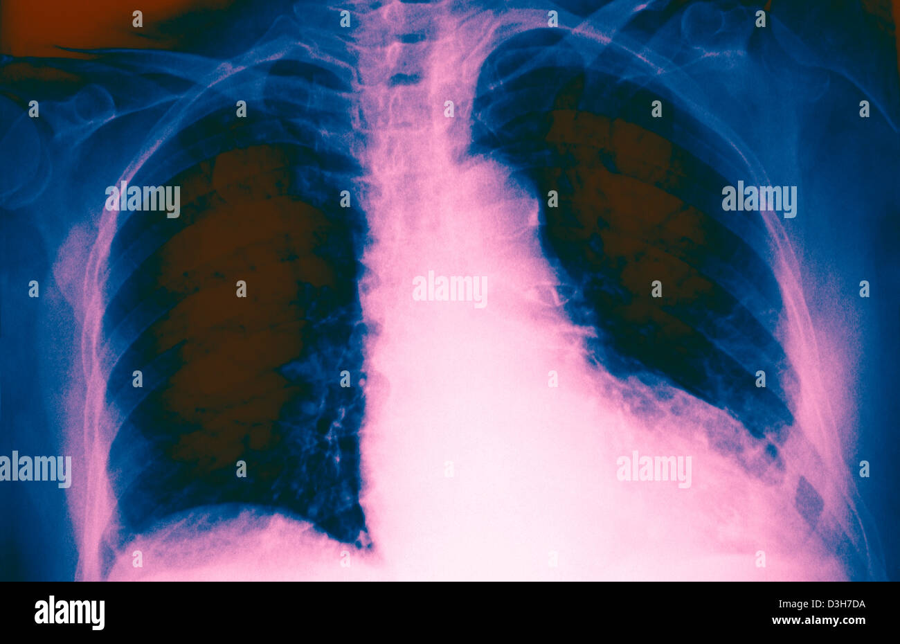 Cardiomegaly hi-res stock photography and images - Alamy