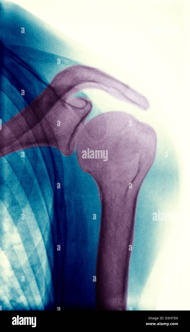 Normal shoulder x ray hi-res stock photography and images - Alamy