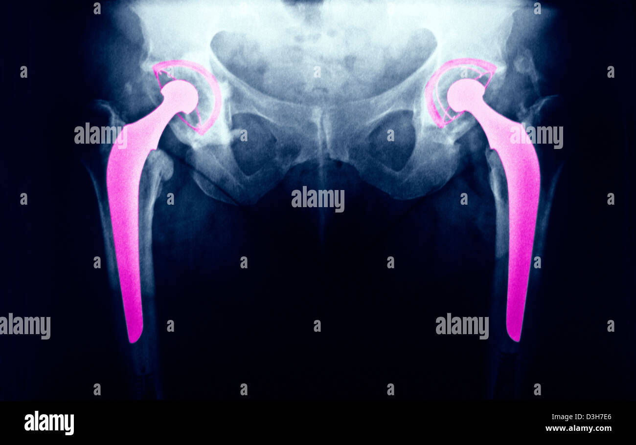 HIP PROSTHESIS, X-RAY Stock Photo - Alamy