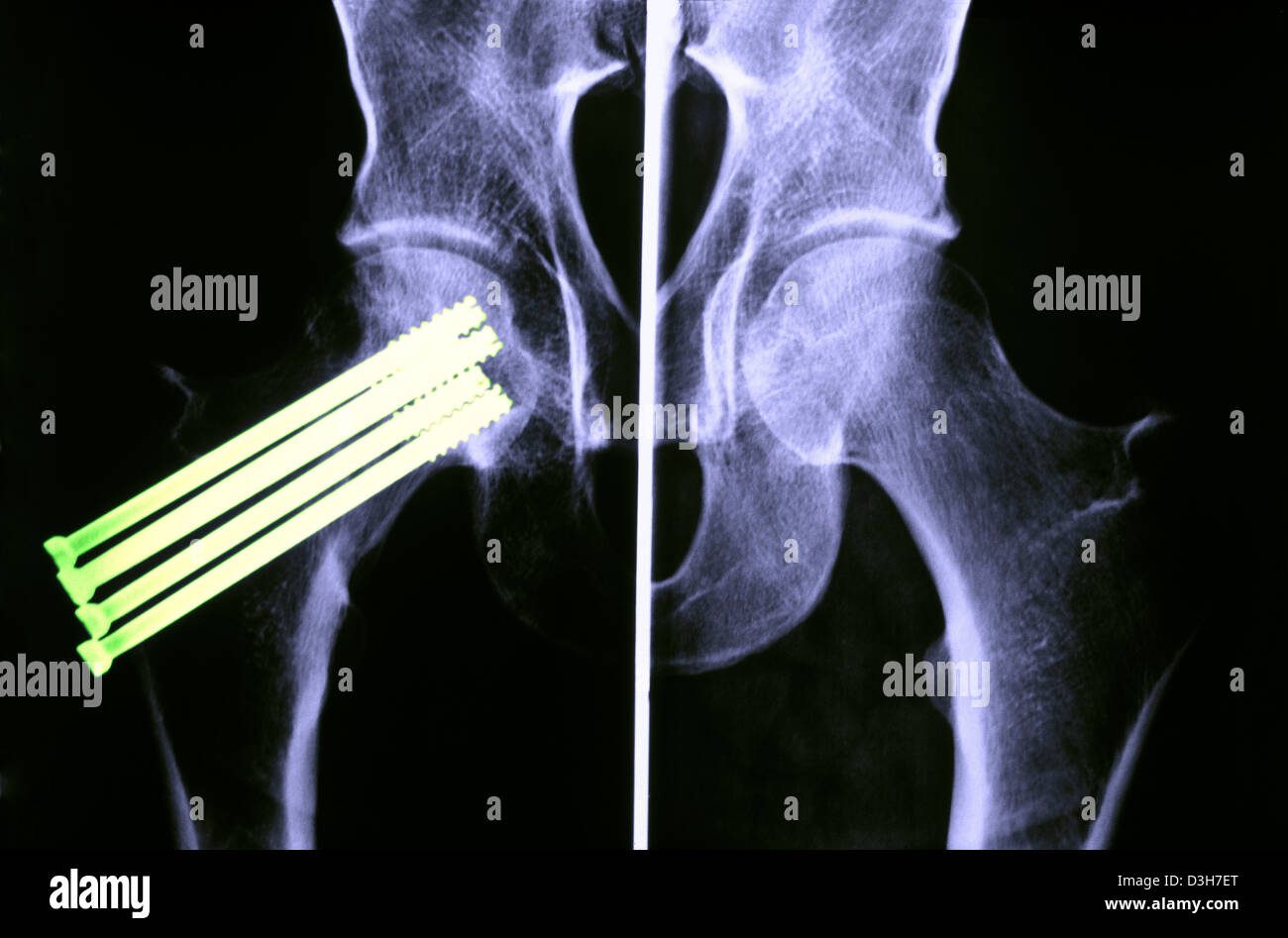 Hip osteosynthesis hi-res stock photography and images - Alamy