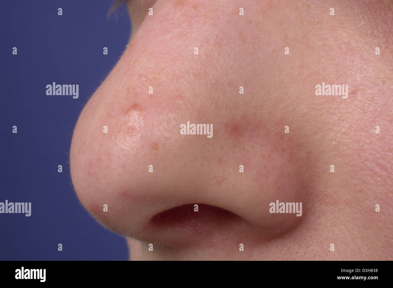Nevus nose hi-res stock photography and images - Alamy