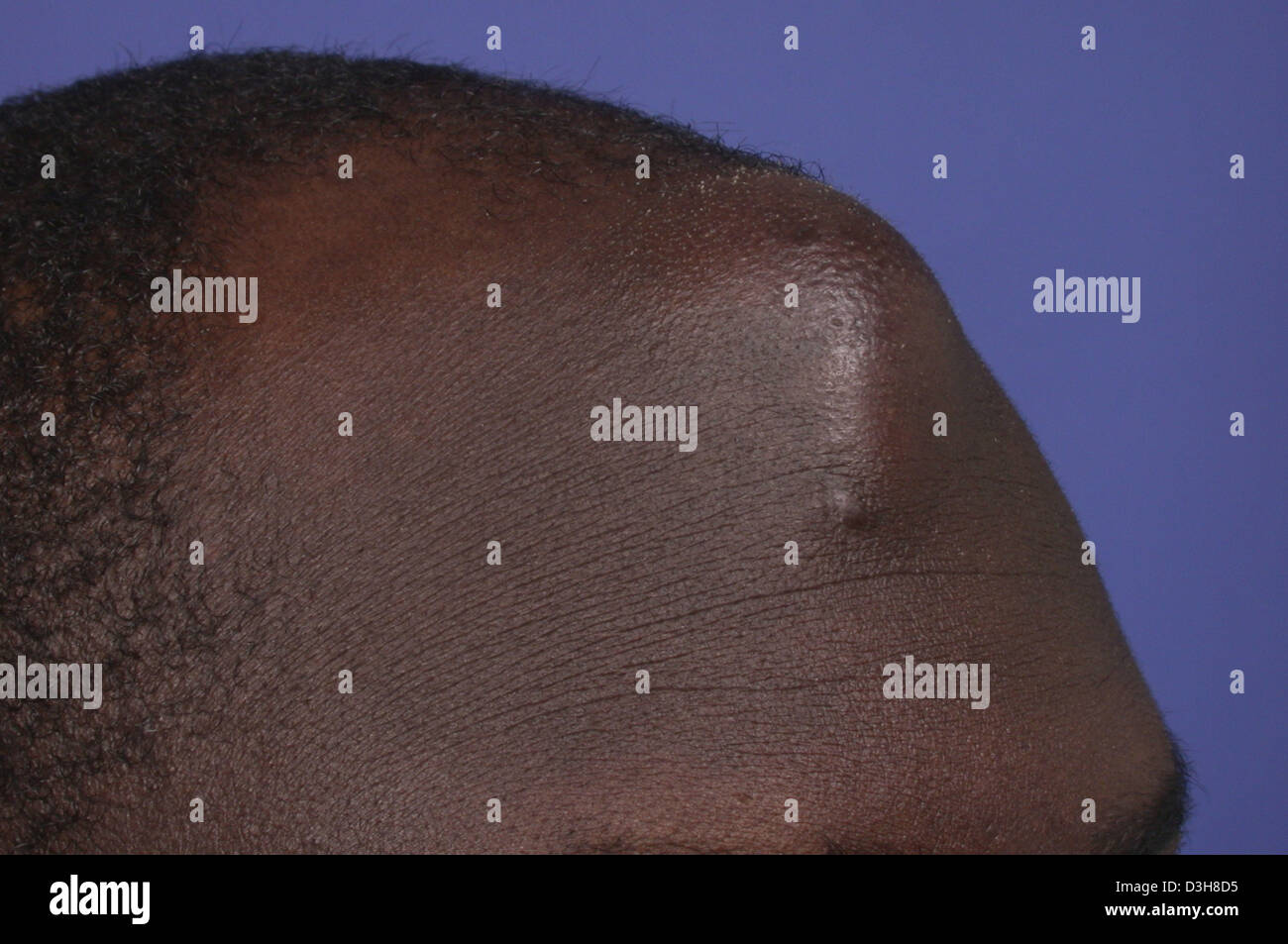 Infected Heads Stock Photos & Infected Heads Stock Images - Alamy