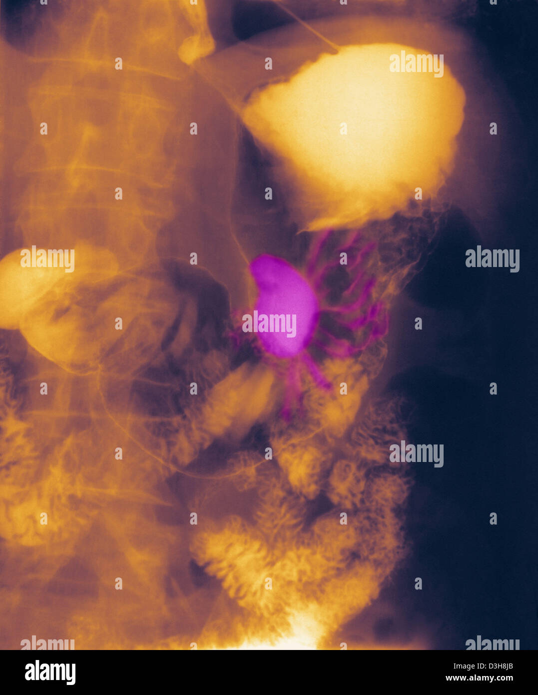 Gastric ulcer x ray hi-res stock photography and images - Alamy
