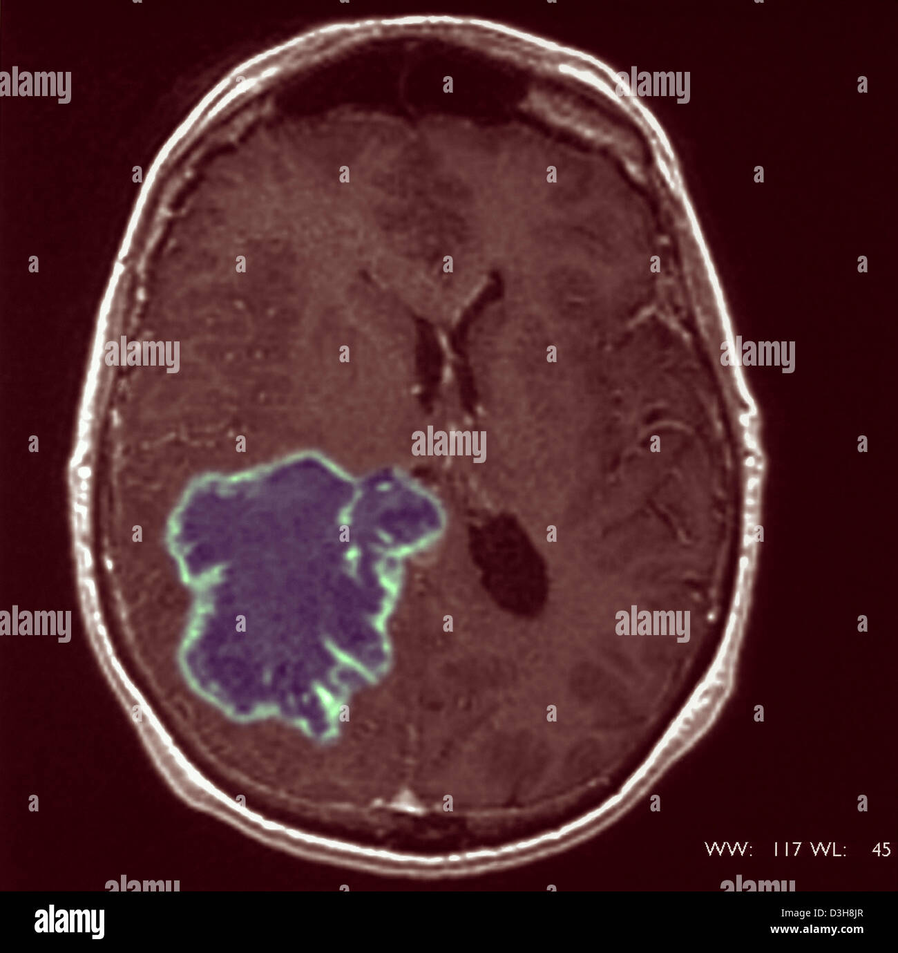 Cardia Cancer High Resolution Stock Photography and Images - Alamy