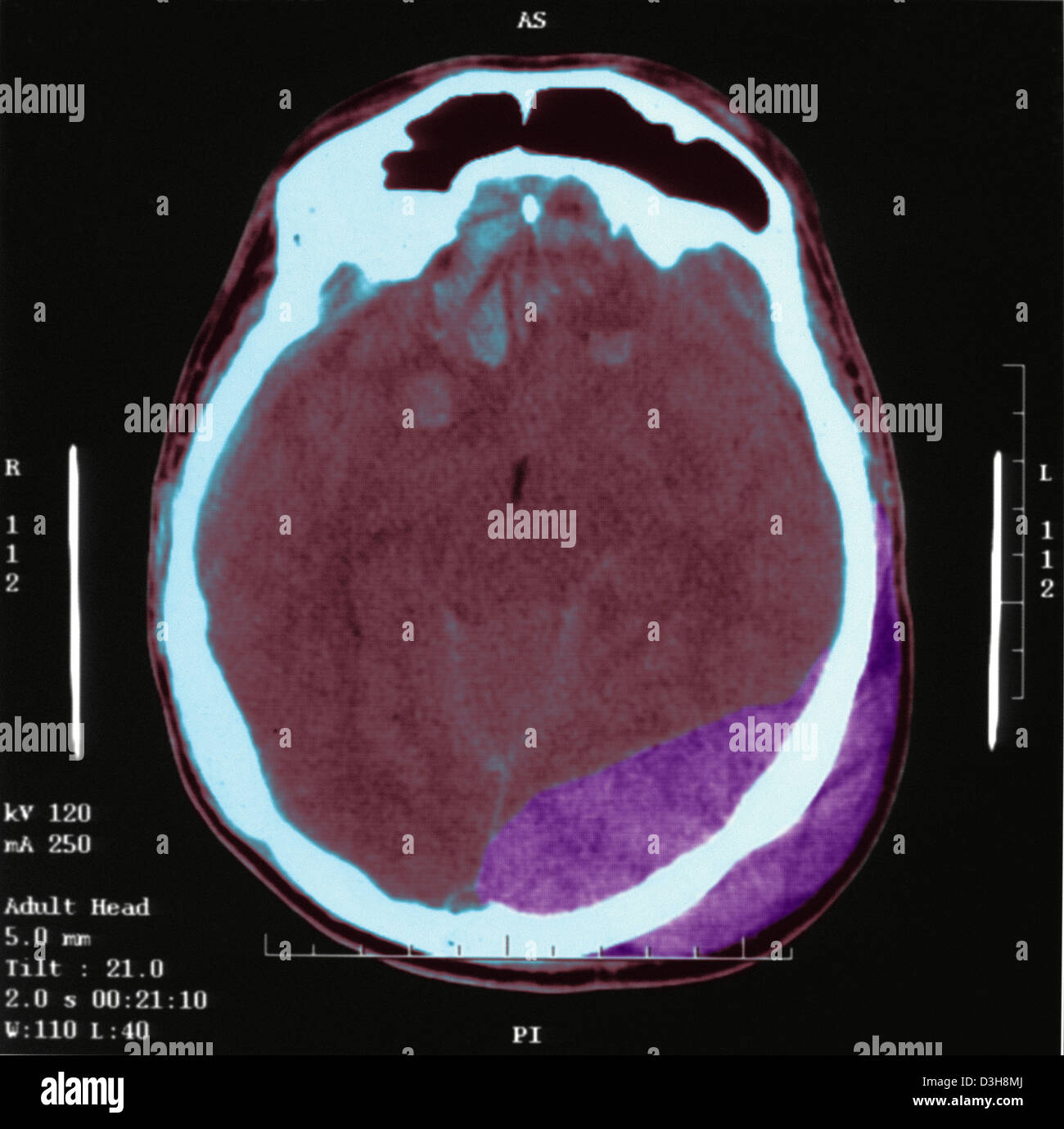 Epidural hematoma hi-res stock photography and images - Alamy