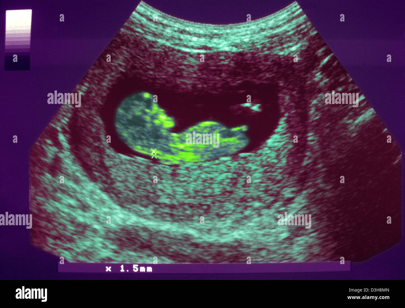 Nuchal translucency ultrasound scan 12 hi-res stock photography and ...