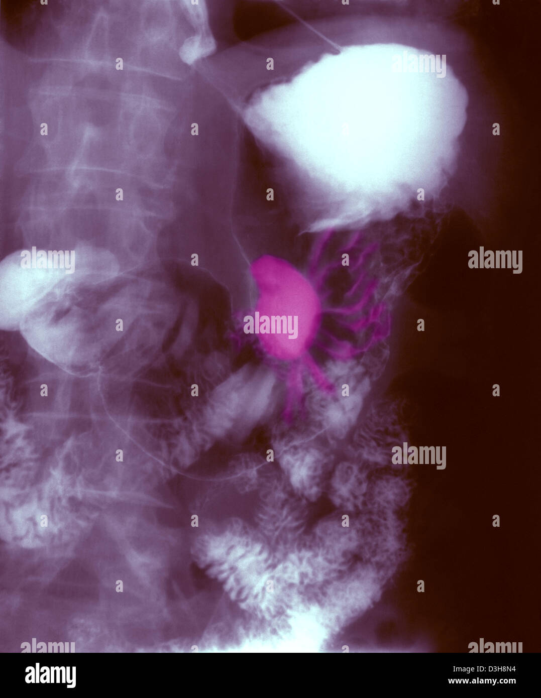 Gastric ulcer x ray hi-res stock photography and images - Alamy