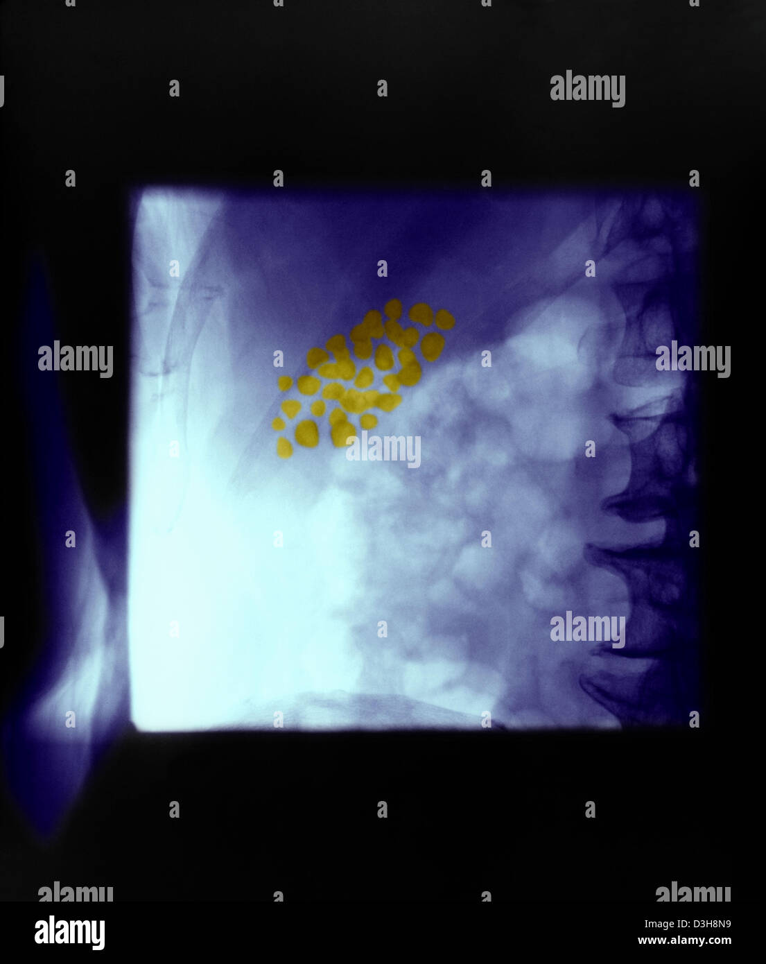 Gallstone x ray hi-res stock photography and images - Alamy