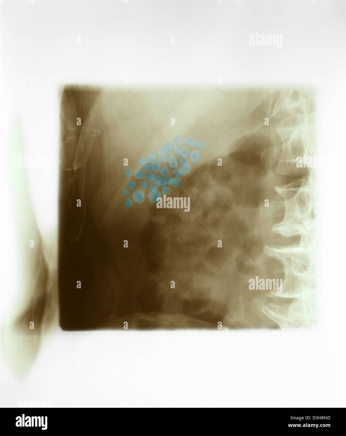 Gallstone x ray hi-res stock photography and images - Alamy