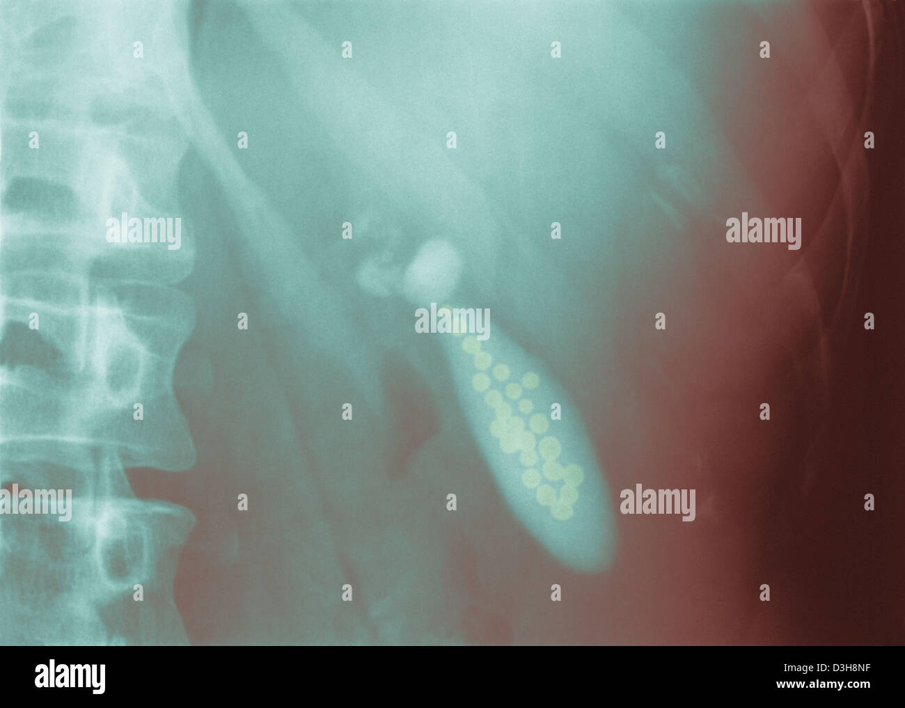Gallstone x ray hi-res stock photography and images - Alamy