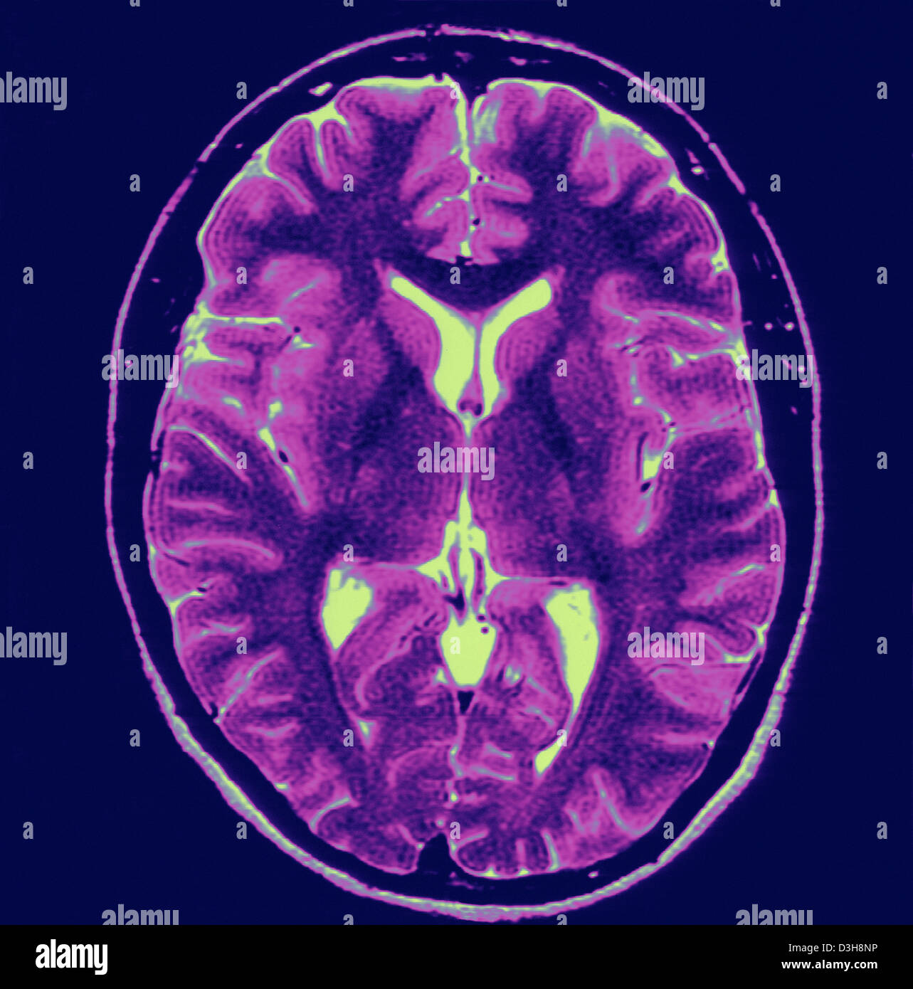 Normal brain scan hi-res stock photography and images - Alamy