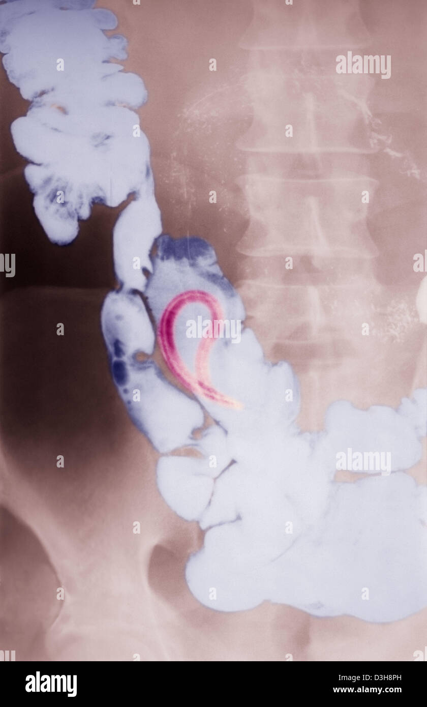 Intestinal roundworms hi-res stock photography and images - Alamy