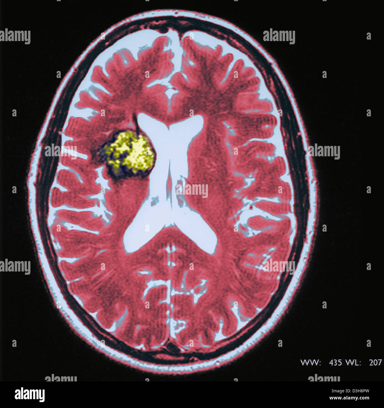 CEREBRAL CAVERNOUS ANGIOMA Stock Photo - Alamy