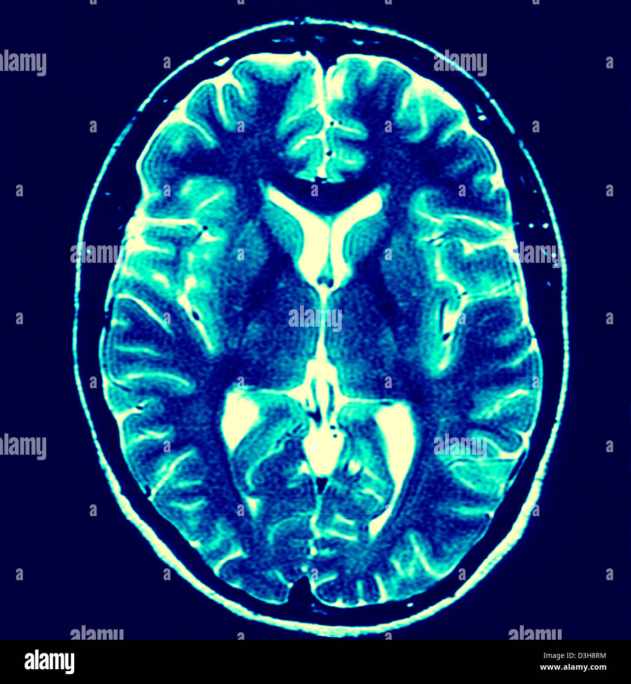 Cat scan brain healthy hi-res stock photography and images - Alamy