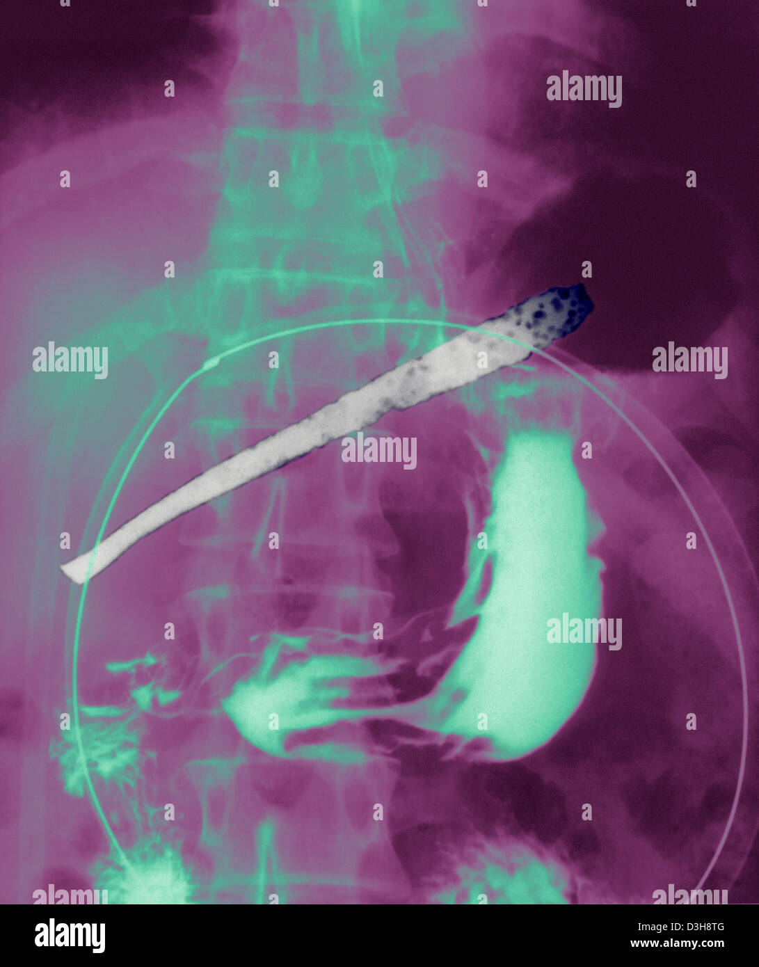 Foreign object body hi-res stock photography and images - Alamy